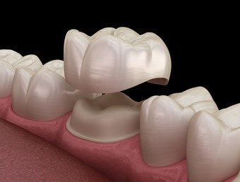 Restorative Treatment – Family Dental Centre